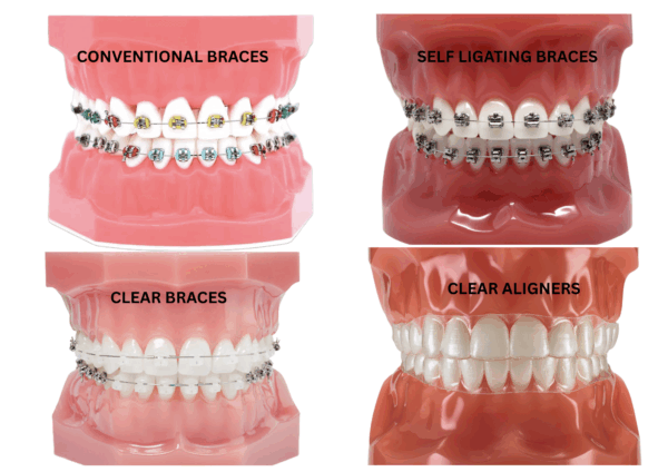 Types of Braces – Which is Right for You? - Pixel Dental Clinic